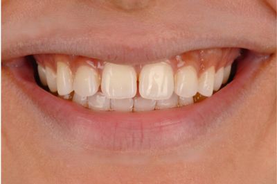 Edge to Edge Bite | Kharsa Clinics