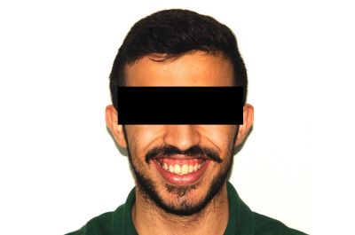 Edge to Edge Bite | Kharsa Clinics