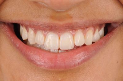 Edge to Edge Bite | Kharsa Clinics