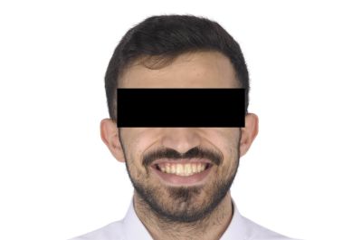 Edge to Edge Bite | Kharsa Clinics