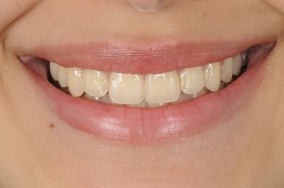 Edge to Edge Bite | Kharsa Clinics