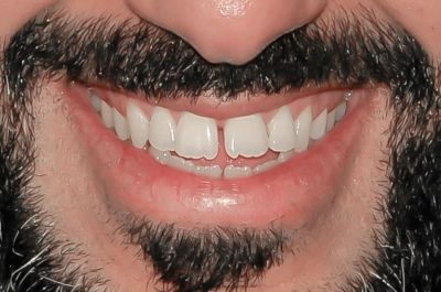 Edge to Edge Bite | Kharsa Clinics