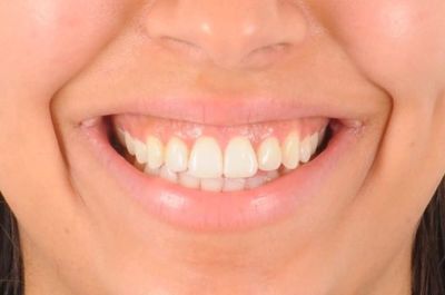 Edge to Edge Bite | Kharsa Clinics