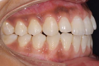 Edge to Edge Bite | Kharsa Clinics