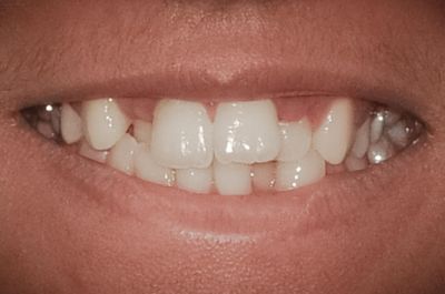 Edge to Edge Bite | Kharsa Clinics