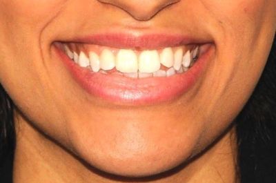 Edge to Edge Bite | Kharsa Clinics