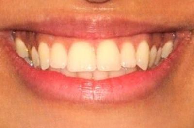 Edge to Edge Bite | Kharsa Clinics