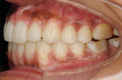 Edge to Edge Bite | Kharsa Clinics