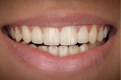 Edge to Edge Bite | Kharsa Clinics