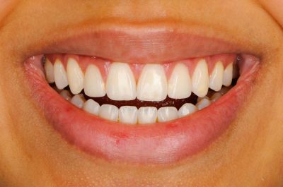 Edge to Edge Bite | Kharsa Clinics