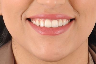 Edge to Edge Bite | Kharsa Clinics